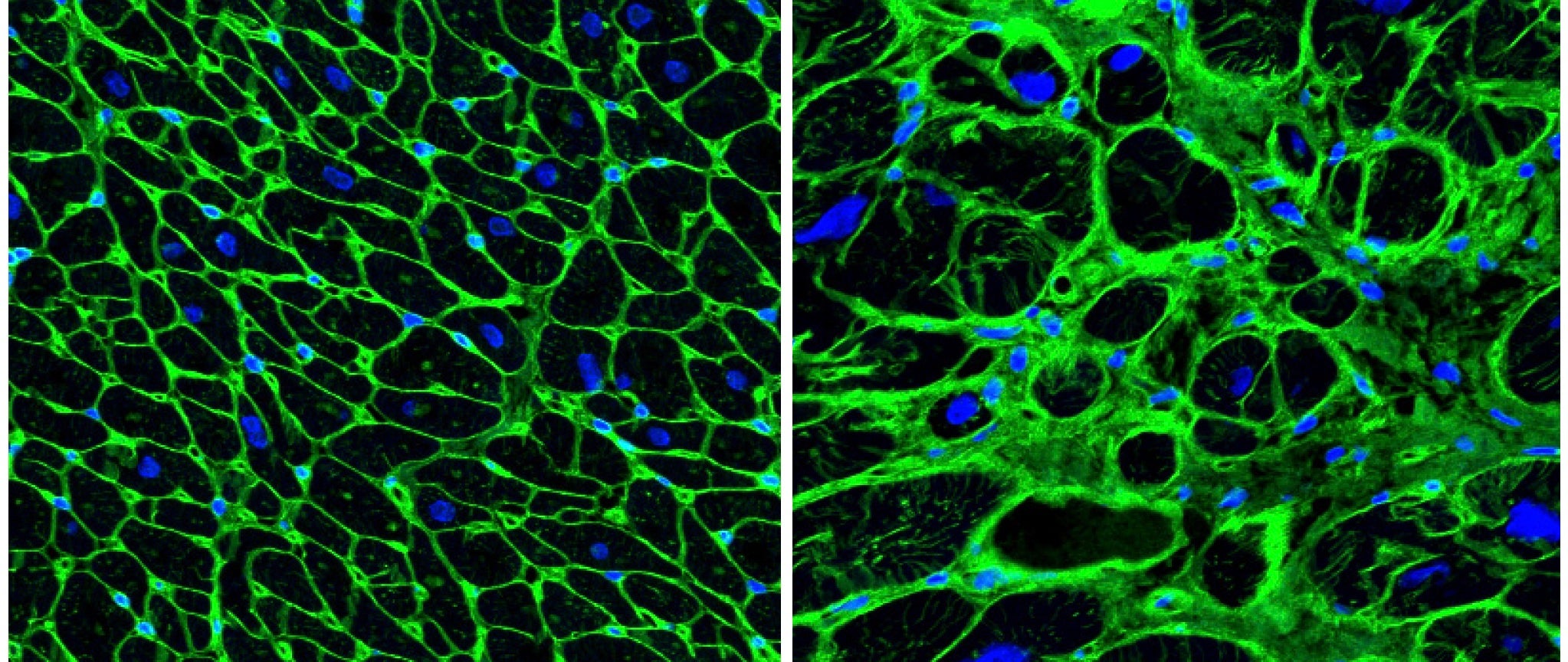 Single cell RNA sequensing uncovers new mechanisms of heart disease ...