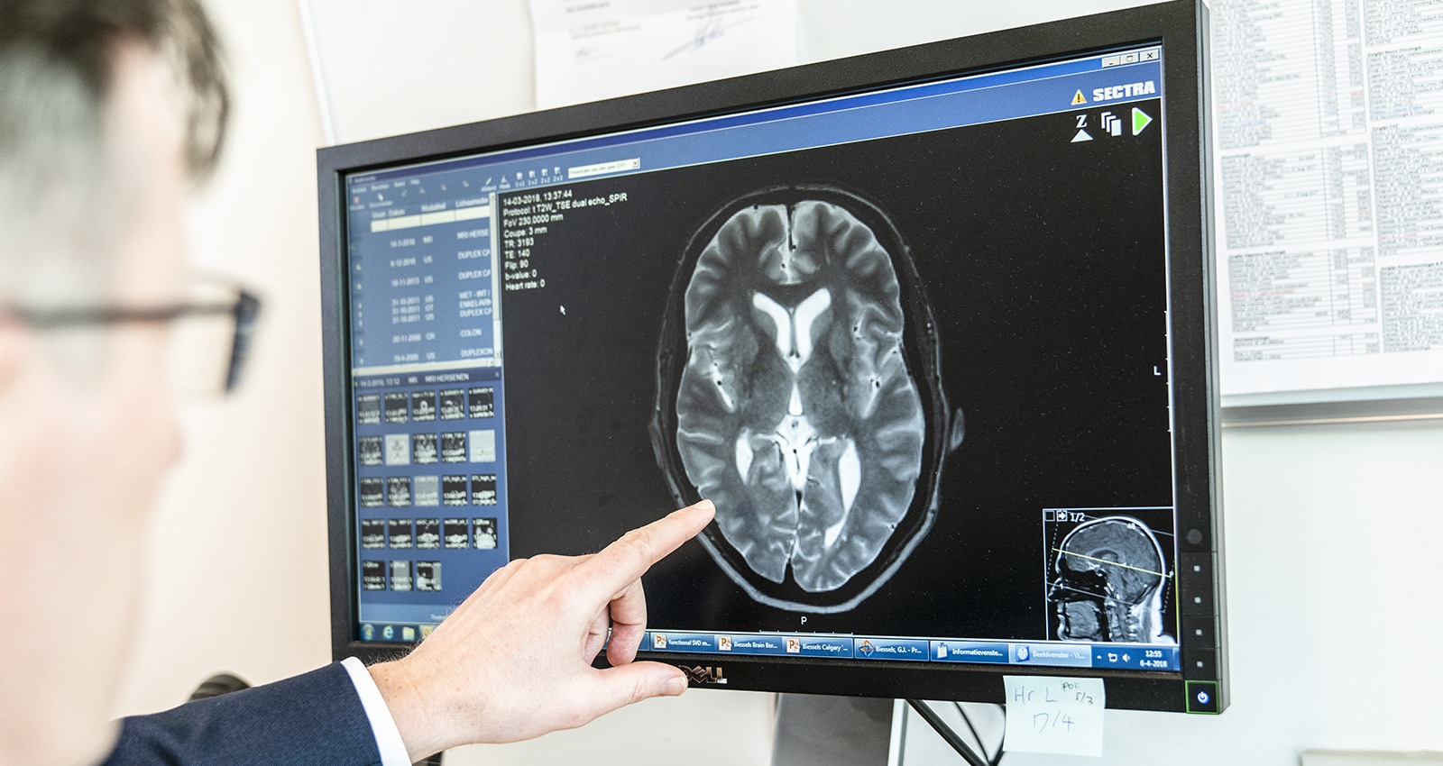 Clarity on vascular damage in brain scans with new reference values ...